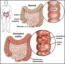 Understanding Ulcerative Colitis | PatientsEngage